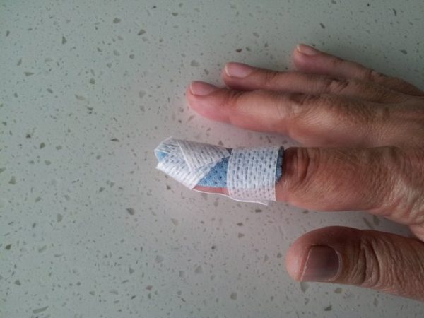 Mallet Splints – PTS